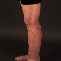 Akromegalie Bilder - Altmeyers Enzyklopädie - Fachbereich Dermatologie