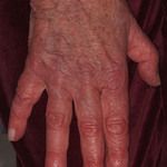 Acrocyanosis - Altmeyers Encyclopedia - Department Dermatology