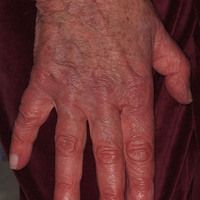 Acrocyanosis Images - Altmeyers Encyclopedia - Department Dermatology