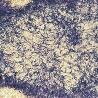 Actinomycosis Images - Altmeyers Encyclopedia - Department Dermatology