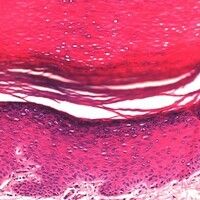 Punctured palmoplantar keratosis type 3 Images - Altmeyers Encyclopedia ...