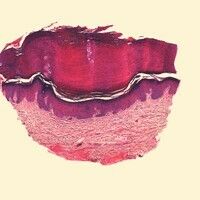 Punctured palmoplantar keratosis type 3 Images - Altmeyers Encyclopedia ...