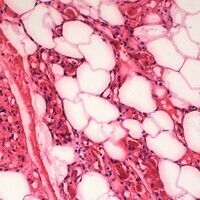 Angiolipom Images - Altmeyers Encyclopedia - Department Dermatology