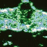 Angiom seniles Bilder - Altmeyers Enzyklopädie - Fachbereich Dermatologie