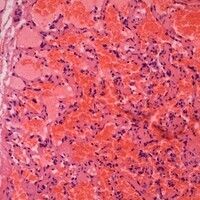 Angiom seniles Bilder - Altmeyers Enzyklopädie - Fachbereich Dermatologie