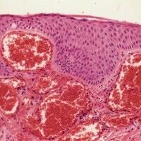 Angiom seniles Bilder - Altmeyers Enzyklopädie - Fachbereich Dermatologie