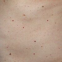 Angiom seniles Bilder - Altmeyers Enzyklopädie - Fachbereich Dermatologie