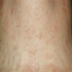Anetodermie - Altmeyers Enzyklopädie - Fachbereich Dermatologie