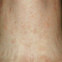 Anetoderma Bilder - Altmeyers Enzyklopädie - Fachbereich Dermatologie