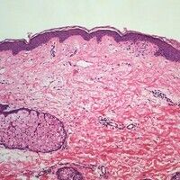 Anetodermie Bilder - Altmeyers Enzyklopädie - Fachbereich Dermatologie