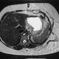 Angiodysplasie Bilder - Altmeyers Enzyklopädie - Fachbereich Gefäßmedizin