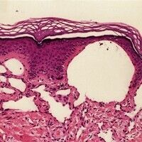 Angiokeratome (Übersicht) Bilder - Altmeyers Enzyklopädie - Fachbereich ...