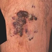 Angiokeratoma circumscriptum Images - Altmeyers Encyclopedia ...