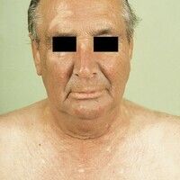 Argyria Bilder - Altmeyers Enzyklopädie - Fachbereich Dermatologie