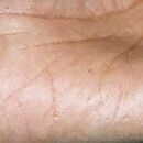 Pseudosarcoma of the skin - Altmeyers Encyclopedia - Department Dermatology