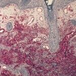 Angiosarkom der Kopf- und Gesichtshaut - Altmeyers Enzyklopädie ...