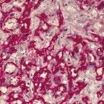 Angiosarcoma of the head and face skin - Altmeyers Encyclopedia ...