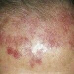 Angiosarkom der Kopf- und Gesichtshaut - Altmeyers Enzyklopädie ...