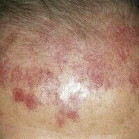 Bilder für Fleck, Gesicht - Altmeyers Enzyklopädie