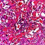 Angiosarkom der Kopf- und Gesichtshaut - Altmeyers Enzyklopädie ...