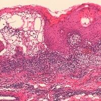Aphthae (overview) Images - Altmeyers Encyclopedia - Department Dermatology