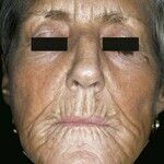 Atrophy of the skin (overview) - Altmeyers Encyclopedia - Department ...