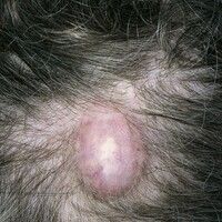 Atherom Images - Altmeyers Encyclopedia - Department Dermatology