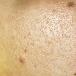 Atrophodermia vermiculata - Altmeyers Enzyklopädie - Fachbereich ...