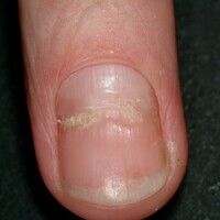 Images for Nail - Altmeyers Encyclopedia