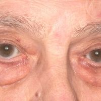 Blepharochalasis Images - Altmeyers Encyclopedia - Department Dermatology