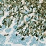 Candida-Sepsis - Altmeyers Enzyklopädie - Fachbereich Innere Medizin