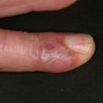 Chilblain-Lupus - Altmeyers Enzyklopädie - Fachbereich Dermatologie