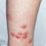 Cimikose - Altmeyers Enzyklopädie - Fachbereich Dermatologie