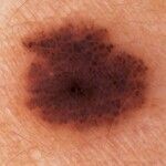 Compound nevus - Altmeyers Encyclopedia - Department Dermatology