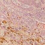 Combined Naevus - Altmeyers Enzyklopädie - Fachbereich Dermatologie