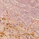 Epitheliom - Altmeyers Enzyklopädie - Fachbereich Dermatologie