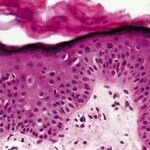 Bowenoids papulose - Altmeyers Encyclopedia - Department Dermatology