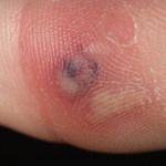 Bulla repens - Altmeyers Enzyklopädie - Fachbereich Dermatologie