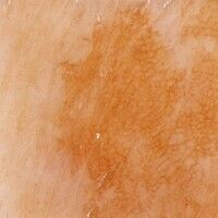 Café-au-lait-Fleck Images - Altmeyers Encyclopedia - Department Dermatology