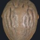 Pachydermie - Altmeyers Enzyklopädie - Fachbereich Dermatologie