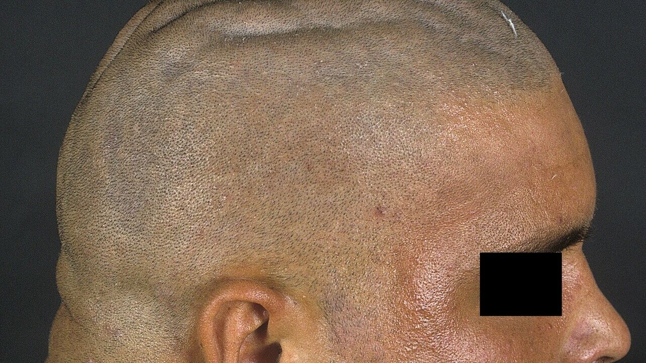 Cutis Verticis Gyrata Surgery Before And After