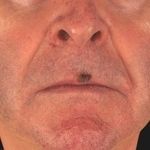 Cornu cutaneum - Altmeyers Encyclopedia - Department Dermatology