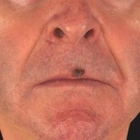 Cornu cutaneum Images - Altmeyers Encyclopedia - Department Dermatology