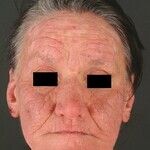 Chronic actinic dermatitis (overview) - Altmeyers Encyclopedia ...