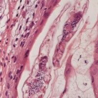 Demodex folliculorum Bilder - Altmeyers Enzyklopädie - Fachbereich ...