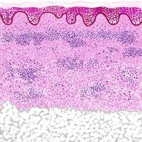 Dermatitis Images - Altmeyers Encyclopedia - Department Dermatology