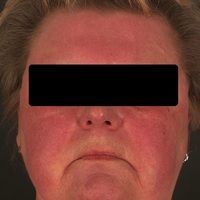 Dermatomyositis (overview) Images - Altmeyers Encyclopedia - Department ...