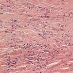 Dermatosclerosis - Altmeyers Encyclopedia - Department Dermatology