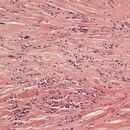 Plectinophathy - Altmeyers Encyclopedia - Department Dermatology