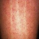 Hba1c - Altmeyers Encyclopedia - Department Internal medicine